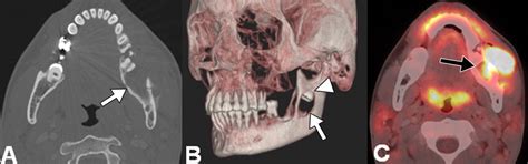 Cystic And Cystic Appearing Lesions Of The Mandible Review Ajr