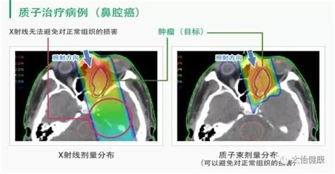 什么是质子重离子放疗 全球肿瘤医生网