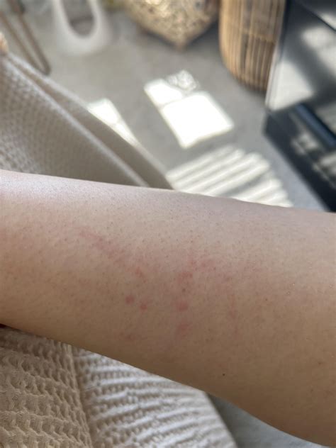 Bug Bites Or Allergic Reaction R Askdoctorsmeeee