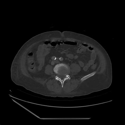 Fileamyloid Arthropathy And Myopathy Mimicking Osteomyelitis With