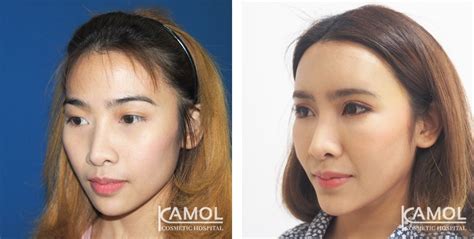 Blepharoplasty Eyelid Surgery