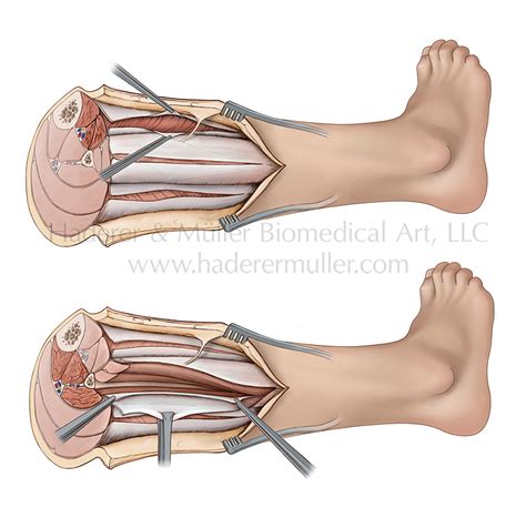 Fasciotomy Haderer And Muller