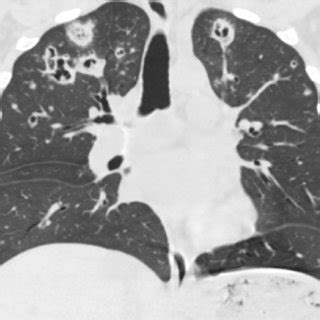 High Resolution Computed Tomography Chest Showing Nodular Cavitary