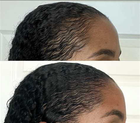 Exosome Treatment For Hair Loss Beverly Hills Ca Raffi Hovsepian Md