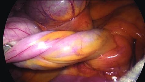 Closed Loop Obstruction With Volvulus Involving The Distal Ileum Download Scientific Diagram