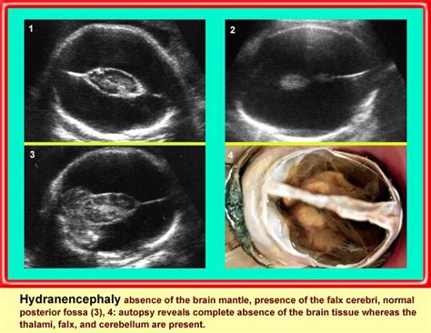 Destructive Brain Lesions Department Of Obstetrics And Gynecology