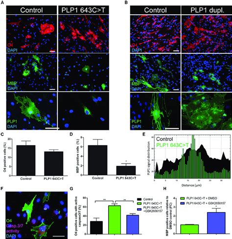 Dc Hiols Derived From Pmd Patients Recapitulate Disease Related