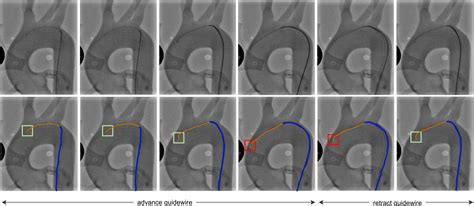 论文评述 Cathaction A Benchmark For Endovascular Intervention Understanding