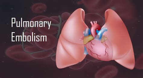 Pulmonary Embolism The Killer Clot In The Lungs MyHeart