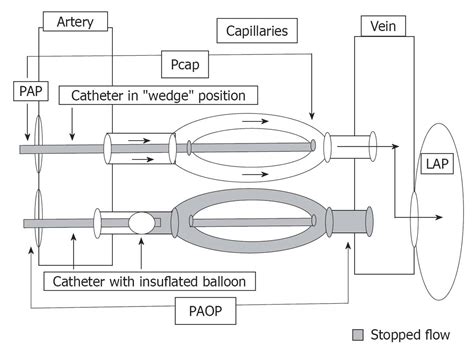 Pulmonary Capillary Wedge Pressure Normal Merysplus