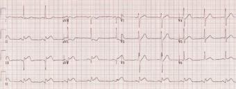 Inferior Stemi • Litfl • Ecg Library Diagnosis