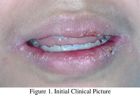 Figure 1 From Drug Related Cheilitis Along With Developed Angular