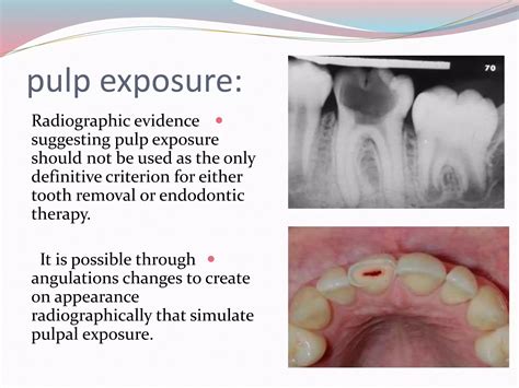 Dental Common Disease On X Ray By Drmohammad Nameer Pptx