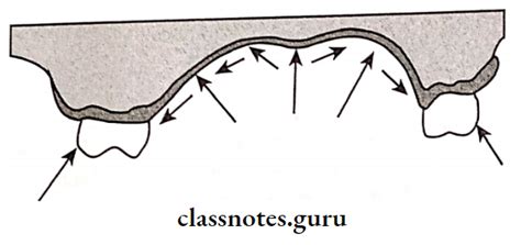 Removable Partial Dentures Long Essays Class Notes