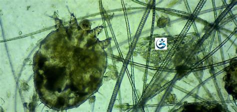 Scabies Infections Are Exploding In The Uk