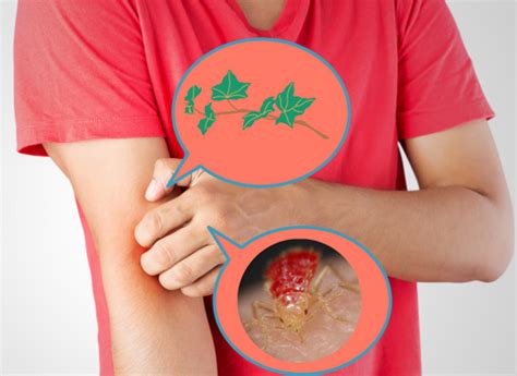 Bed Bug Bite Poison Ivy Rash Determining Which Is Causing Your Red