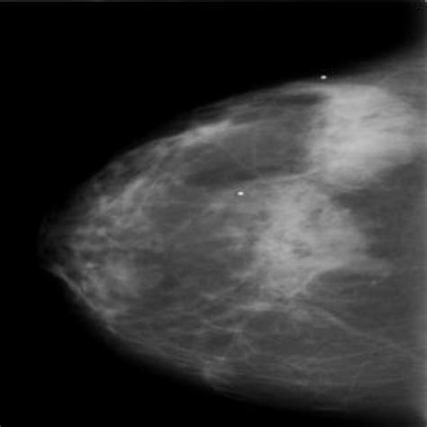 Breast Tumor Object Detection Dataset And Pre Trained Model By Brcan