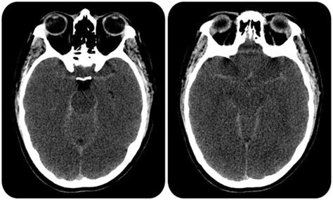 Neurology Volume 78 Number 8