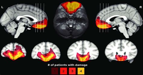 Orbitofrontal Cortex Damage To This Brain Region Impairs Decision