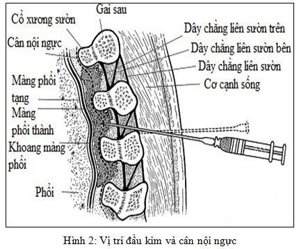 Sau khi gây tê tủy sống mổ thoát vị bẹn có bị đau lưng không Vinmec