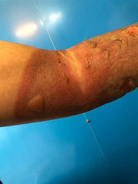 سوختگی چیست؟ سوختگی همه آن چیزی که باید بدانیم کلینیک التیام