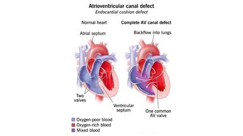 Atrioventricular Canal Defect Endocardial Cushion Defect