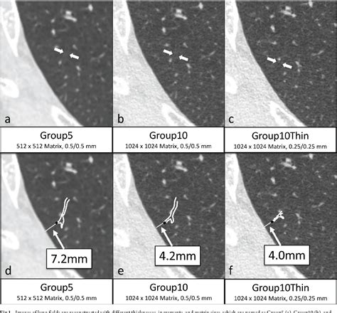 figure 1 from evaluation of peripheral bronchiole visualization using
