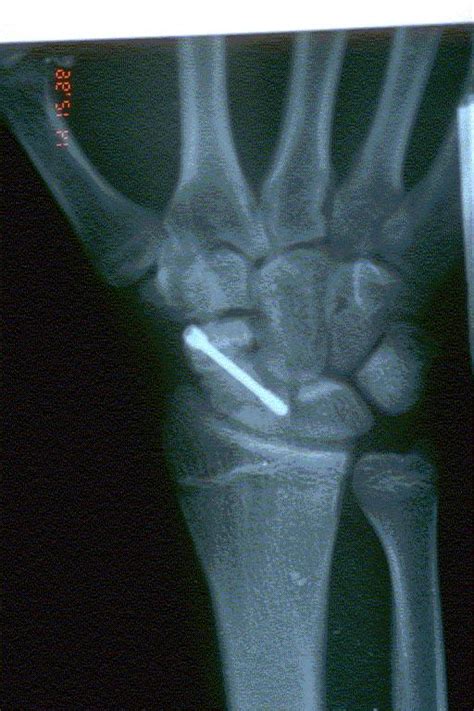 Surgical Treatment Of Scapholunate Advanced Collapse Slac Wrist Pdf