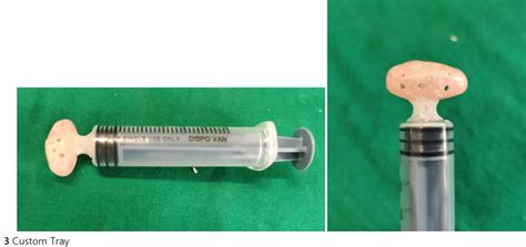 Figure 1 From Prosthetic Rehabilitation Of An Ocular Defect A Case