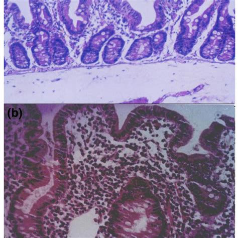 Intestinal Mucosa Showing Environmental Enteropathy A Biopsy Of The