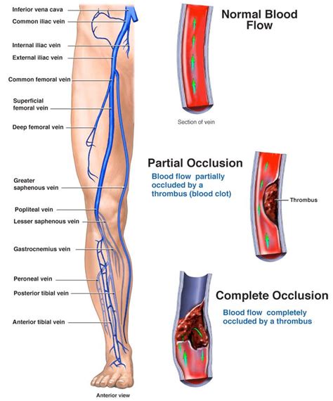 Arterial Thrombosis Vs Venous Thrombosis