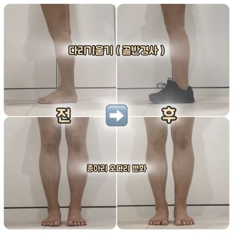 아치핀 깔창 골반틀어짐 교정 평발 증상 후기 네이버 블로그