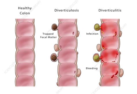Comparison Of Diverticulosis And Diverticulitis Stock Image C039 4378 Science Photo Library
