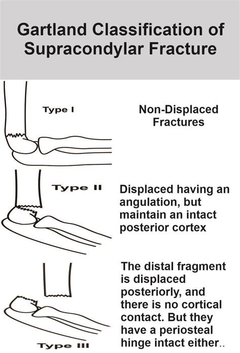 Supracondylar Fracture Types