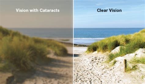 Cataract Vision Simulation