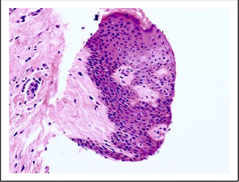 Figure 2 From Classification Of The Seborrheic Keratosis Semantic Scholar