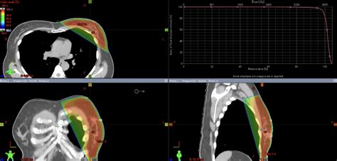 3d Eclipse Breast L Planning Mds School