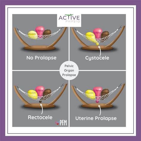 Active Physio 🌟pelvic Organ Prolapse Awareness Month🌟