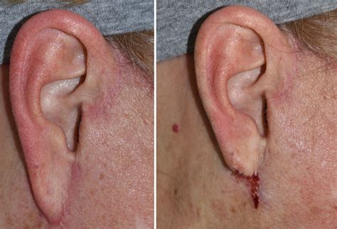 Plastic Surgery Case Study Direct Approach For Pixie Ear Deformity