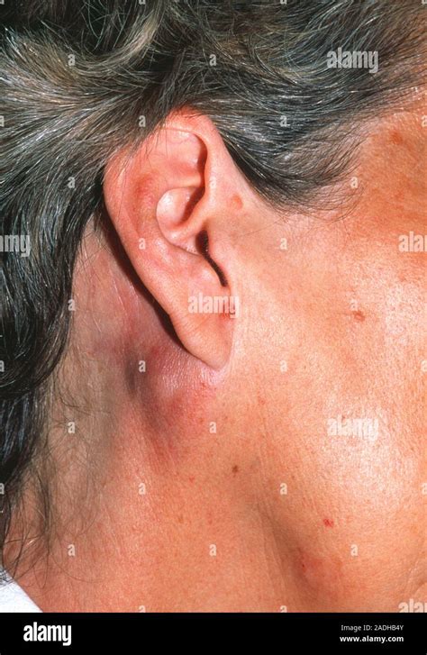 Lymphoma Behind Ear Skin Cancer Hidden Behind Ear Dermoscopy