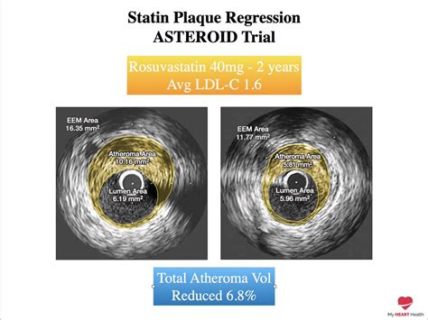 Is It Possible To Reverse Coronary Artery Disease I Get This Question