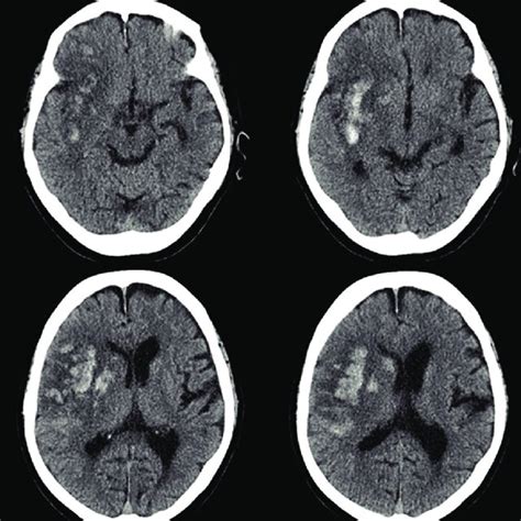 Non Contrast Ct Head Scan Acute Infarction In The Right Mca Territory