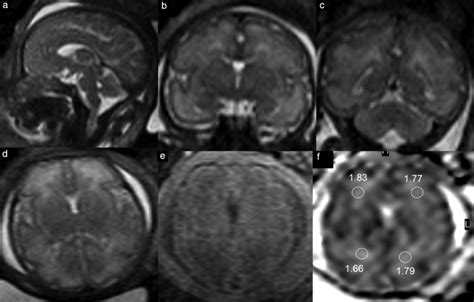 Fetal Brain Magnetic Resonance Imaging Mri In Fetus With Severe