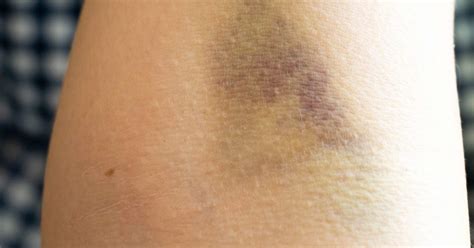 Blood Draw Bruise Autocad Space