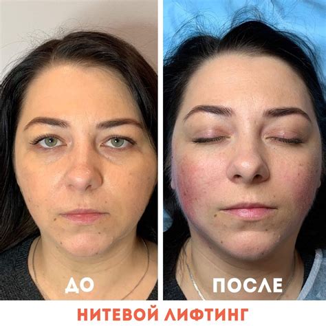 Косметические Нити коги фото до и после подтяжки последствия