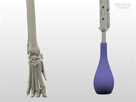 Davide Decesari On Linkedin Intraosseous Transcutaneous Amputation Prosthesis Itap By Dr Fabio…