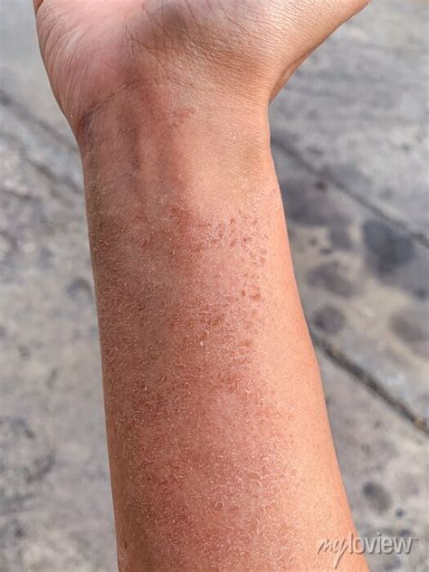 Closeup Dried Rash Of Allergic Contact Dermatitis On Forearm Posters