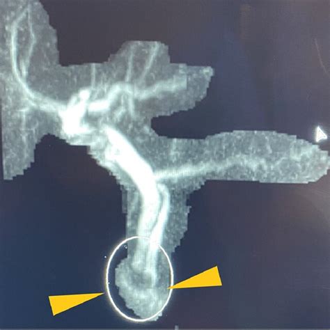 Ercp Showed Abnormal Bulging Papillae With Malignant Appearing