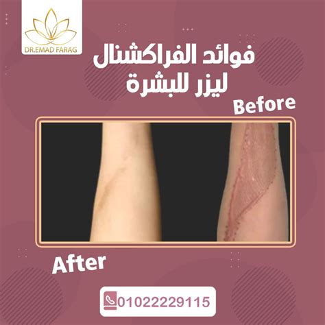 فوائد الفراكشنال ليزر للبشرة دكتور تجميل دكتور عماد فرج