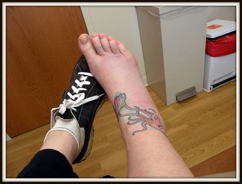 Broken ~ Badly Sprained Right Ankle Broken Ankle Bone 48 Flickr